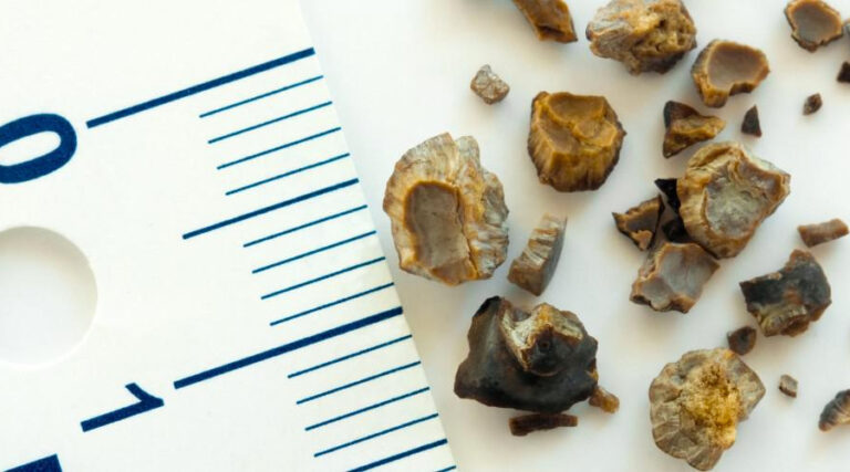 How To Flush Oxalates From The Body: The Oxalate Detox